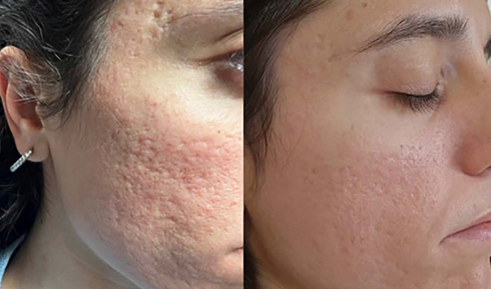 MultiFrax™ | Portable Dual-Wavelength Fractional Laser